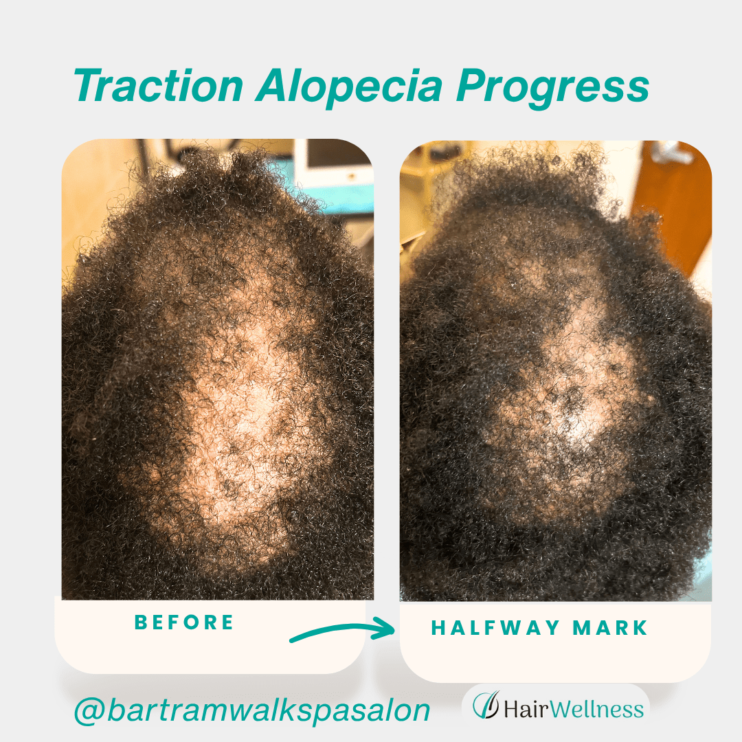 Traction Alopecia: How to Reverse Tension-Induced Hair Loss with a ...